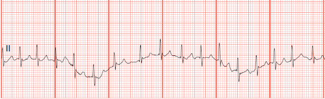 Float Nurse: Basic EKG Rhythm Test 42