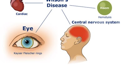 Ayurvedic Treatment For Wilson disease - Dr. Vikram's Blog - Ayurvedic ...