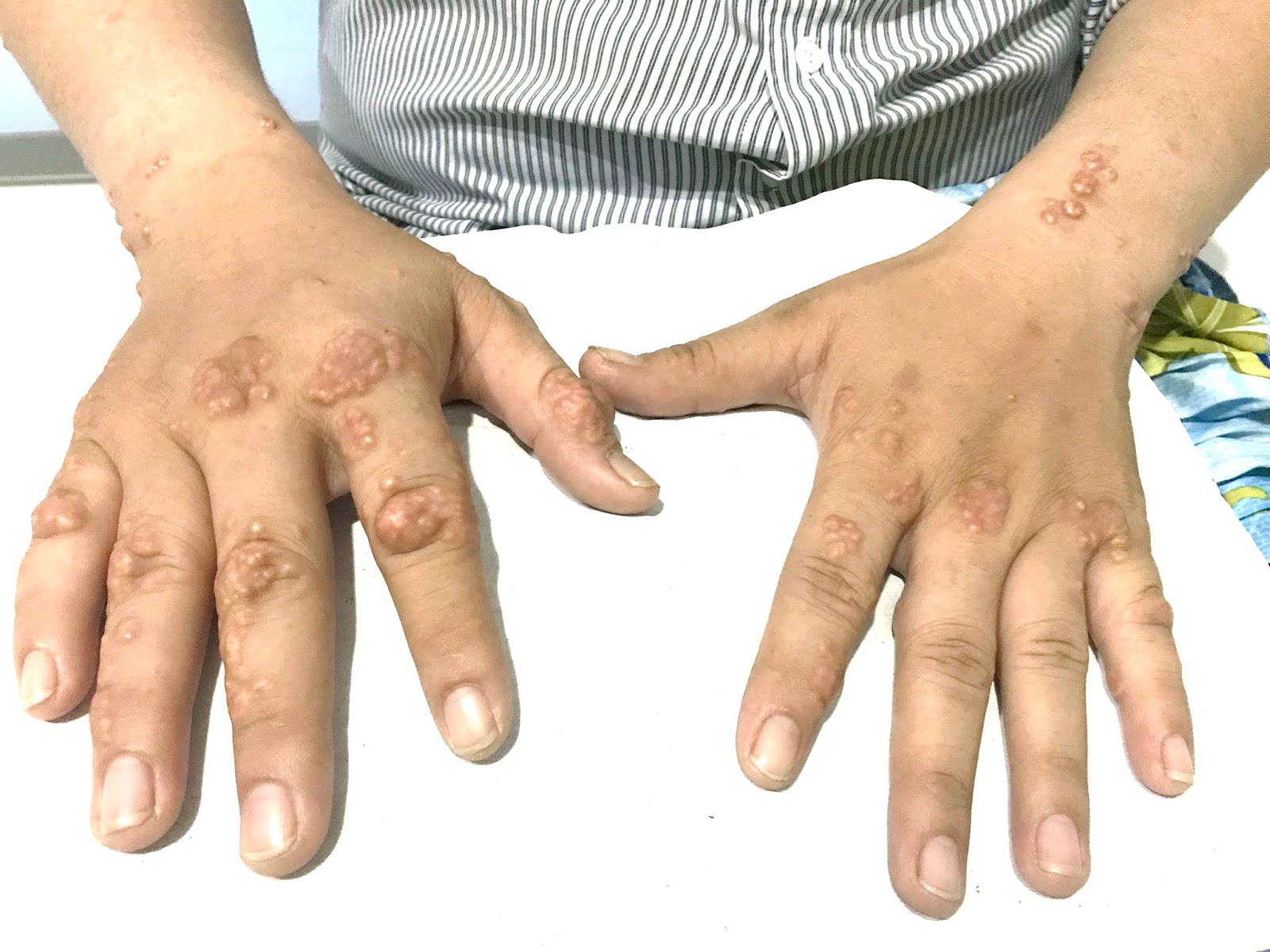 Tendon Xanthomata Rated Medicine