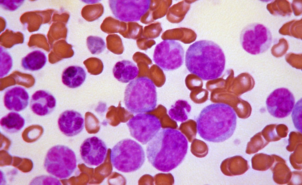 Blood Cancer Chronic Diseases - HEALTH