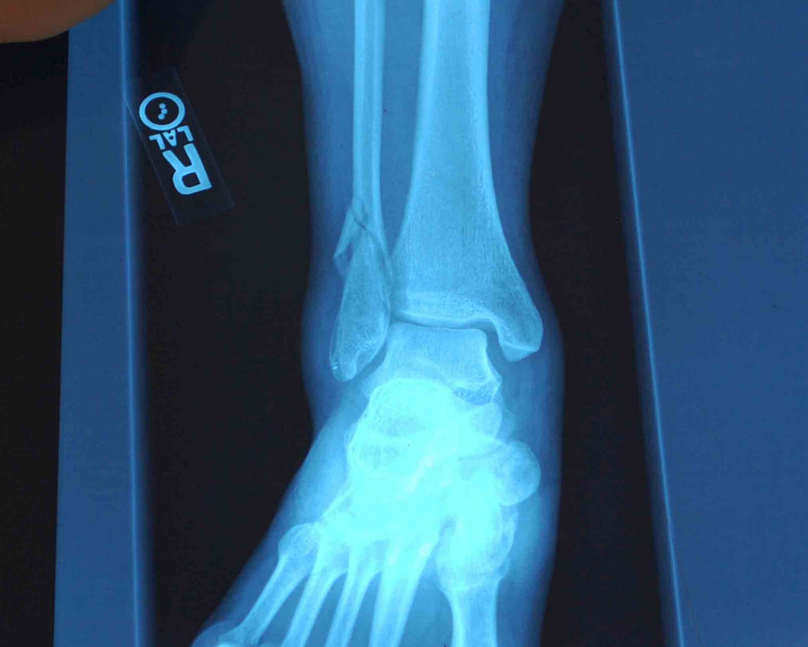 Xray Of Childs Foot