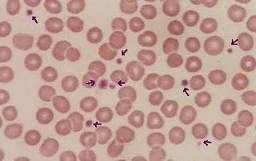 fichero hematologia: Trombocitosis