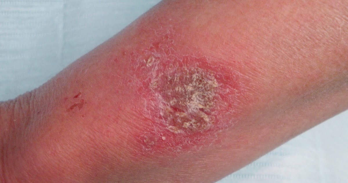 VIRTUAL GRAND ROUNDS IN DERMATOLOGY 2.0: FitBit Dermatitis