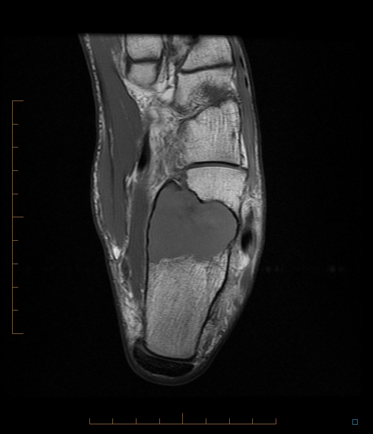 Radiology Cases: Unicameral Bone Cyst