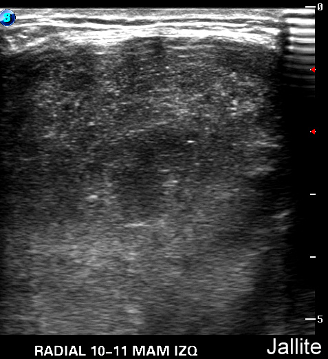 Tumor Filoides de Mama