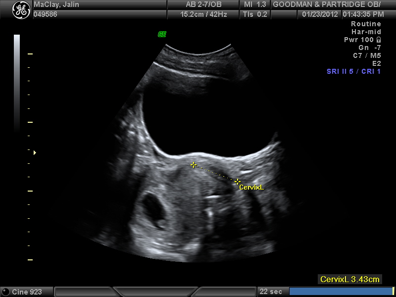 The Merrell Family: 7 weeks and 5 days Ultrasound Pictures