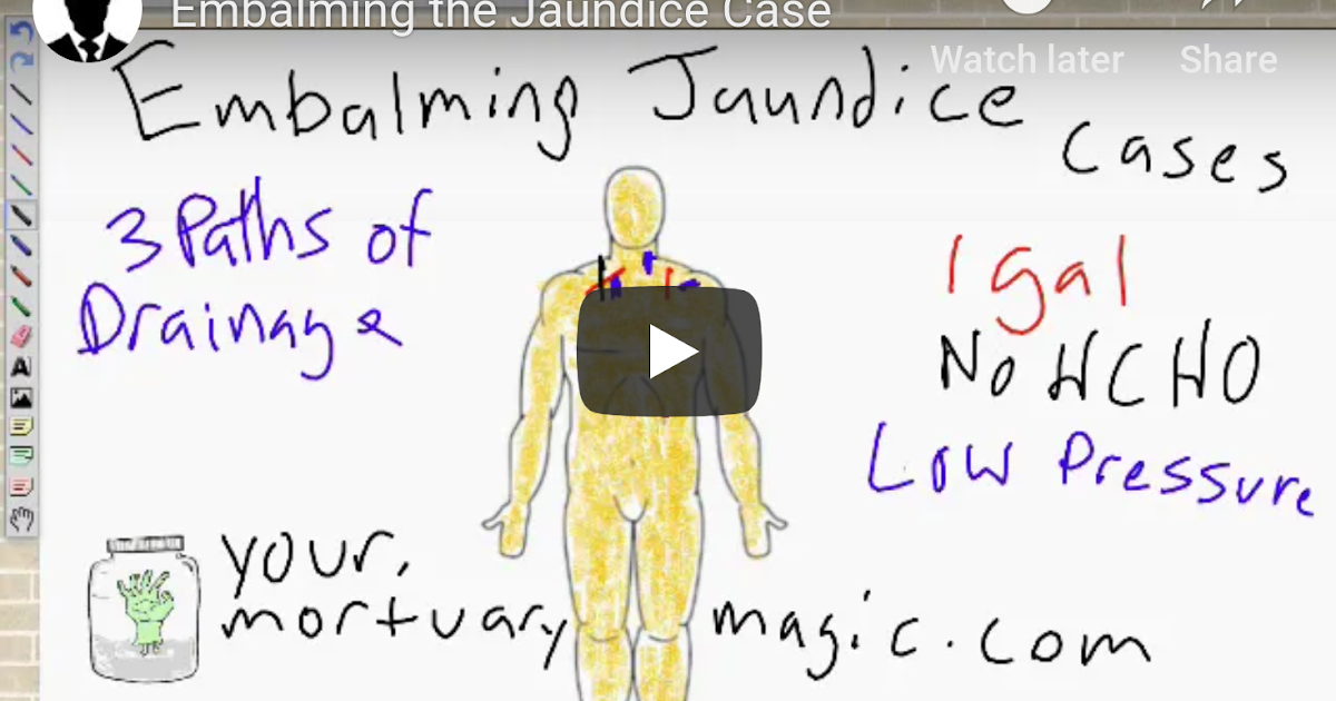 → Embalming the Jaundice Case- Training Video
