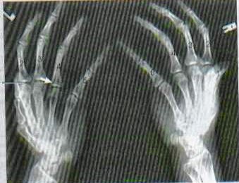 Pemeriksaan Radiografi Ossa Manus 4 ~ Bocah Radiography