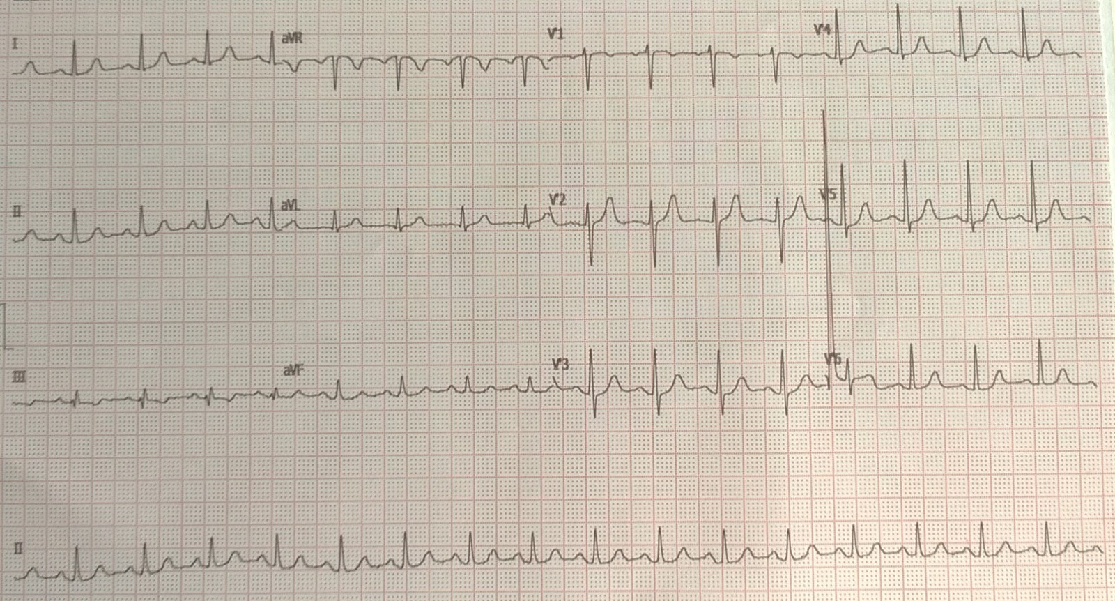 Cardiology window: ECG-Tachycardia in young female ??What is your diagnosis