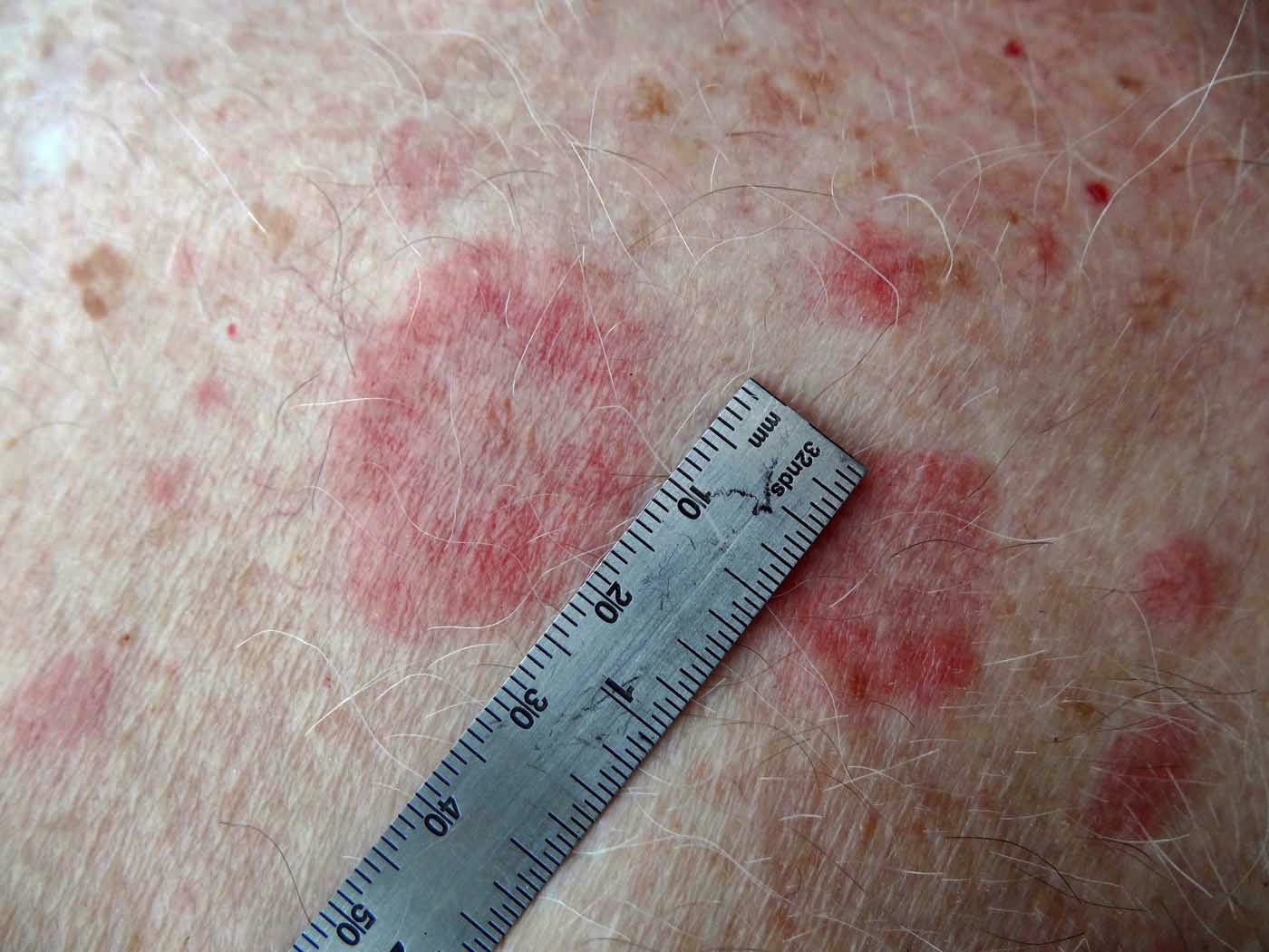 VIRTUAL GRAND ROUNDS IN DERMATOLOGY 2.0: 72 yo man with malaise, rash ...