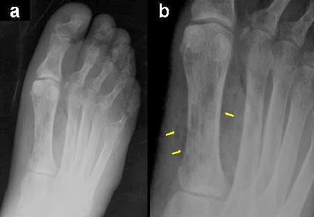Tecnicos Radiologos: Pie diabético: hallazgos en Diagnóstico por Imagen ...