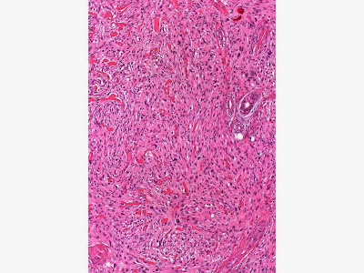 Dermpath Made Simple - Neoplastic: Atypical Fibroxanthoma