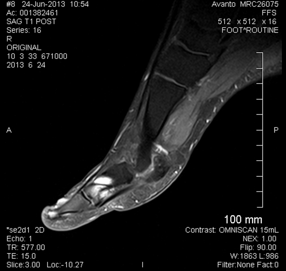 wtf is wrong with my toe???: Toe MRI