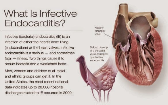 Infective Endocarditis
