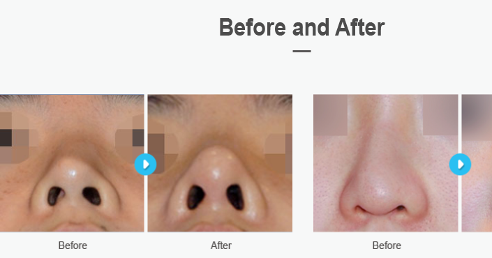 [Nose:Rhinoplasty] Deviated Nasal Bridge Correction