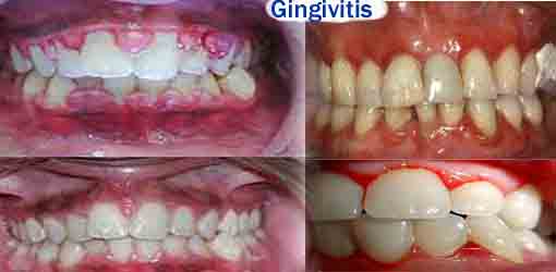 Gingivitis tratamiento y solución | Blog salud, sobre tratamiento de ...
