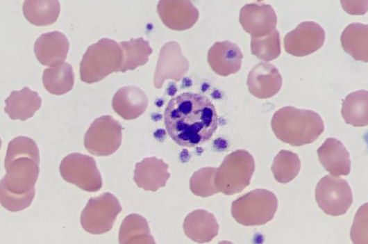 Medical Laboratory and Biomedical Science: Platelet Satellitism