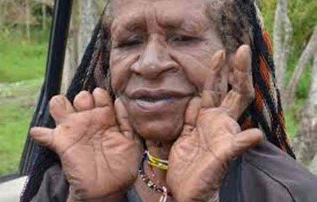 The finger-cutting tradition of Indonesia's Dani tribe