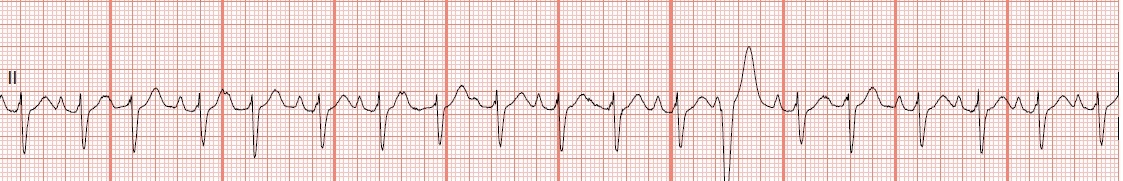 EKG Rhythm Strip Quiz 28