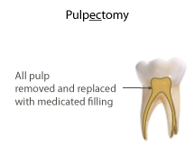 Dentistry and Medicine: Pulp therapy for primary teeth