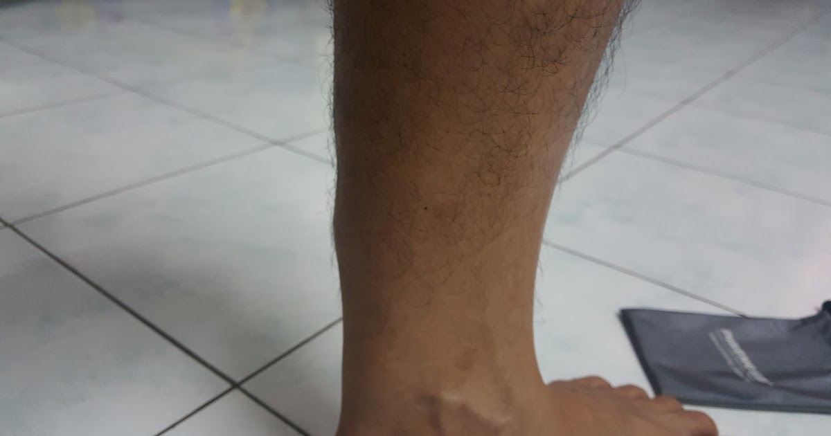 Tanakampung: Putus Urat Keting (Achilles Tendon Rupture)