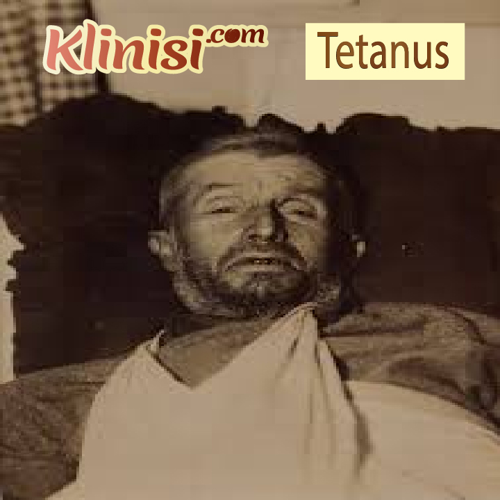 Tetanus / Penyakit Saraf / Neurologi