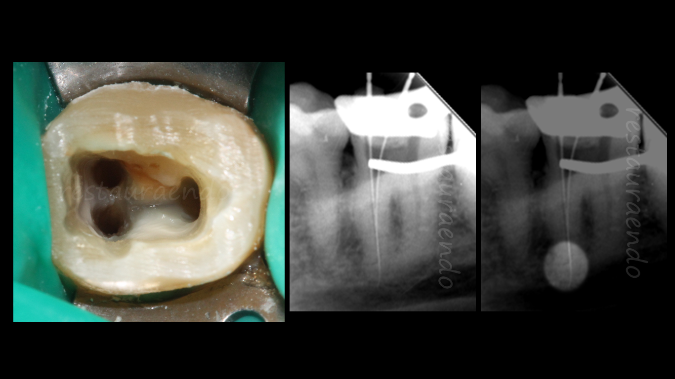 Máster en Odontología Restauradora y Endodoncia: Instrumentación y ...