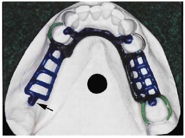 hiphoplife: Tissue Stops in RPD