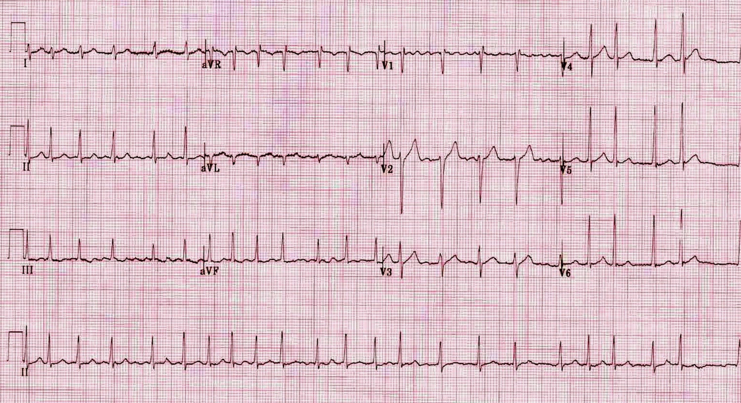 Atrial Fibrilasi | INA - ECG