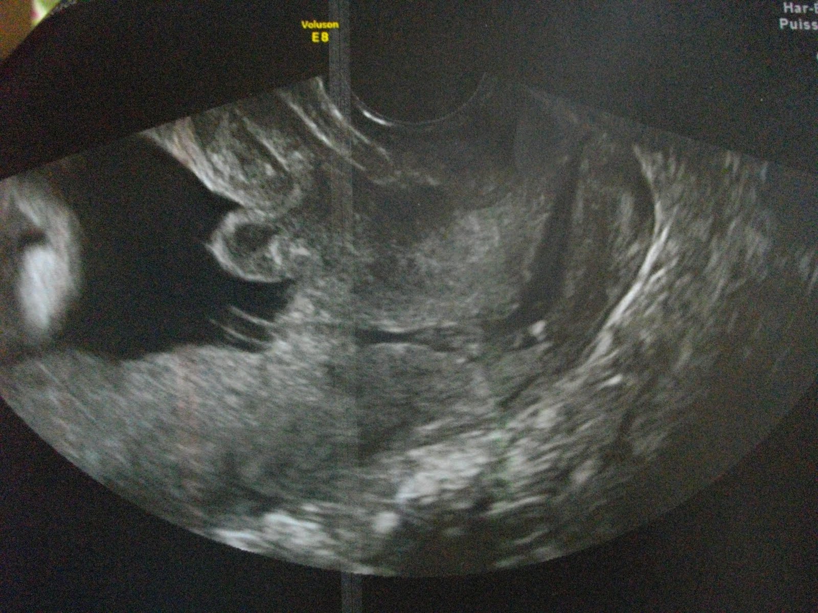 Notre miracle arrive en septembre: Echo Morpho à 16Sa +3