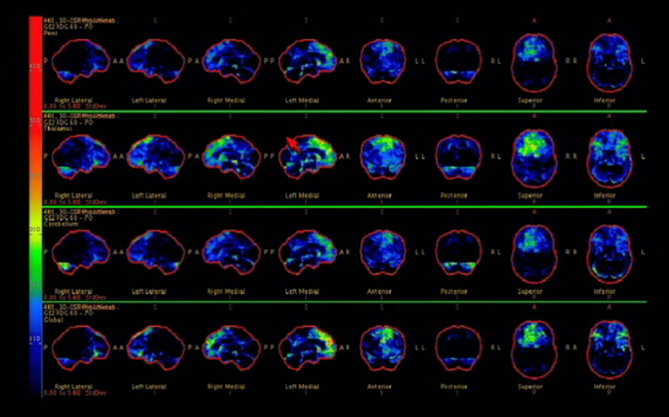 rsna: FDG PET for dementia