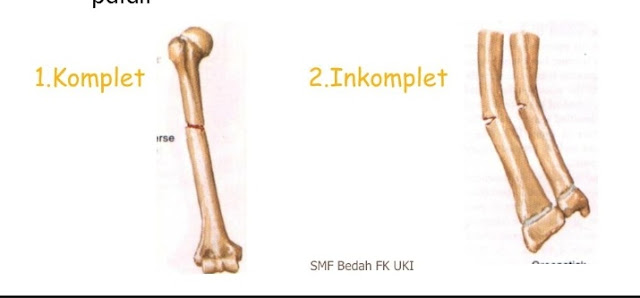 Jenis Dan Kategori Tulang Patah