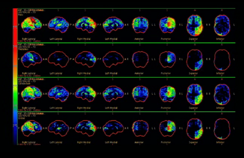 rsna: FDG PET for dementia