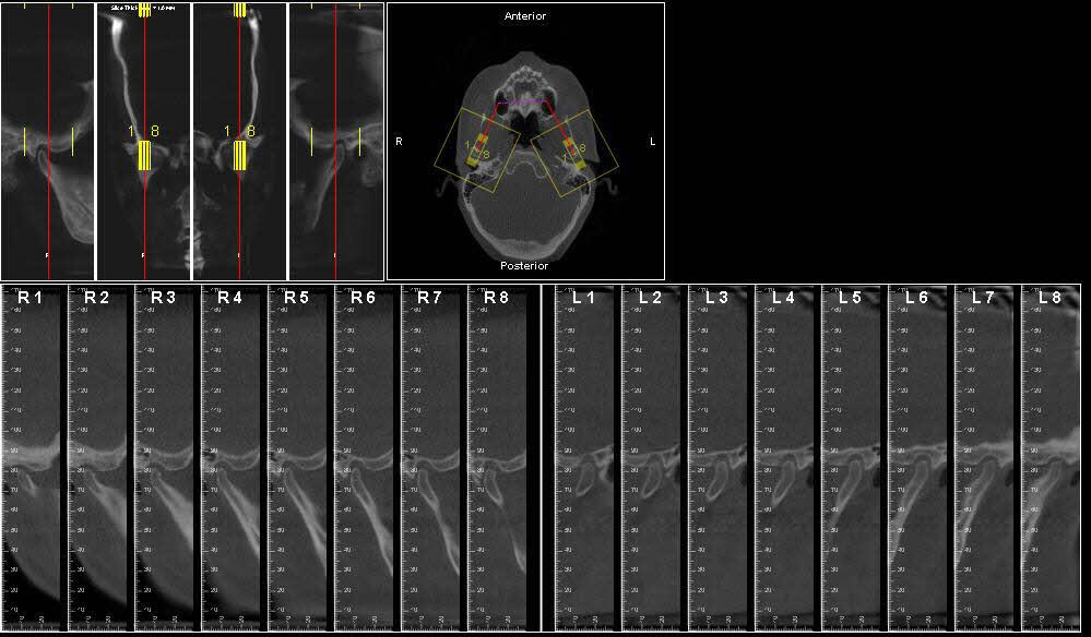 My Lingual Frenectomy and Orofacial Therapy: Recent Orthodontic ...