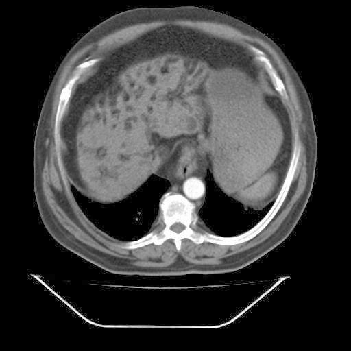 Bilharzial periportal fibrosis-CT - Sumer's Radiology Blog