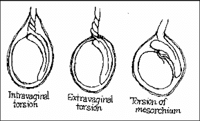 Torsion Testicular Bell Clapper Deformity Twisting Types Triggered ...