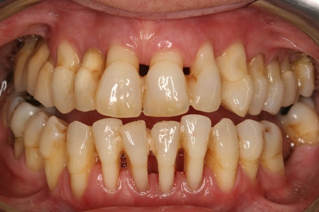 PERIODONTITIS ~ Cuidados De La Salud Oral