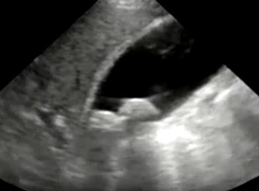 Emergency Medicine. A free ebook online.: Acute abdominal pain ...