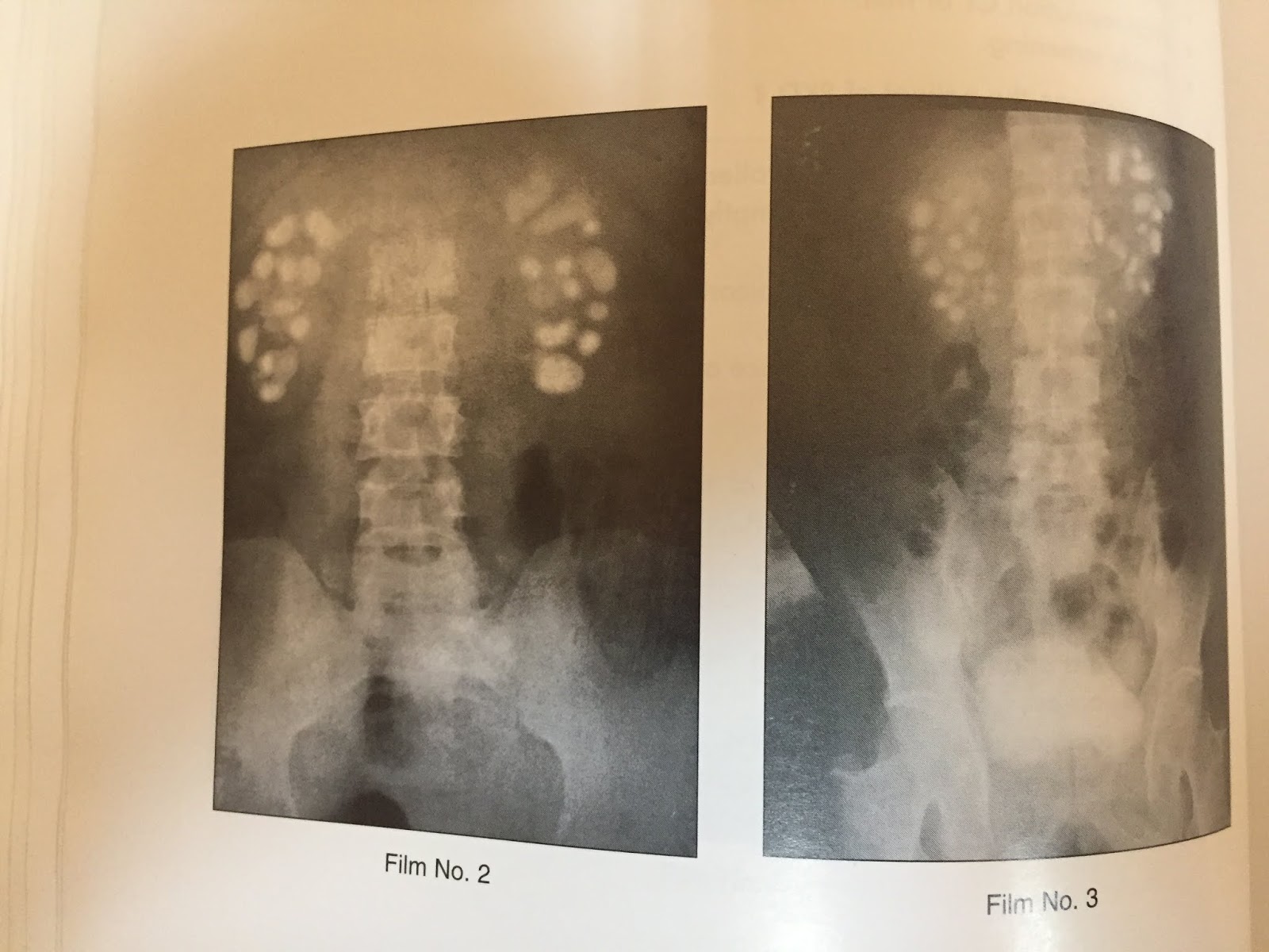 XRAYS OF NEPHROCALCINOSIS