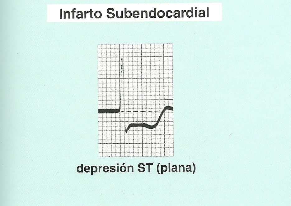 Electrocardiograma y Medicina General: Infarto subendocárdico
