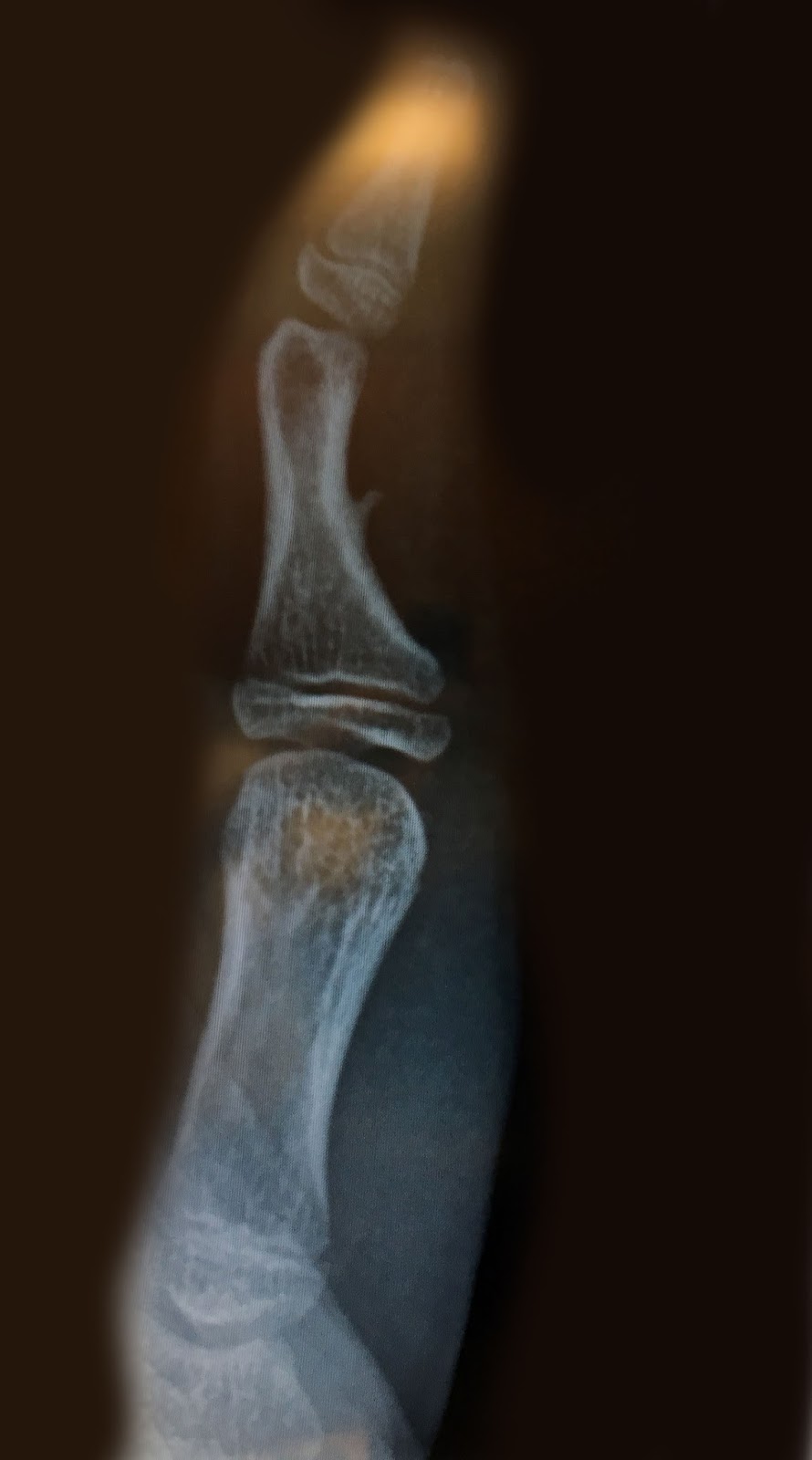 Hand Anomalies and Adoption | Congenital Hand and Arm Differences ...