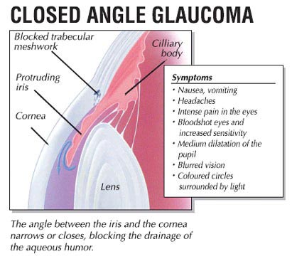 Best Guide on Glaucoma and How to Avoid Permanent Loss of Vision ...