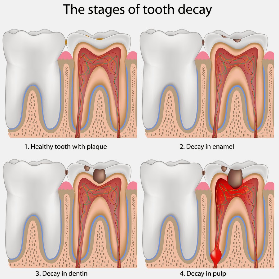 calcified nerves in teeth - Teeth Bonding