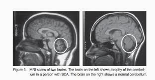 Medical Treatment Pictures-for Better Understanding: Machado-Joseph Disease