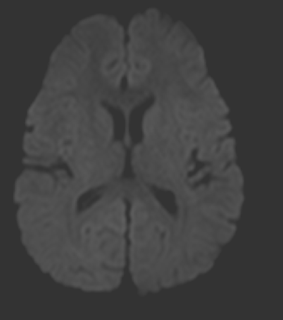 Opercular Syndrome-MRI - Radiology Imaging