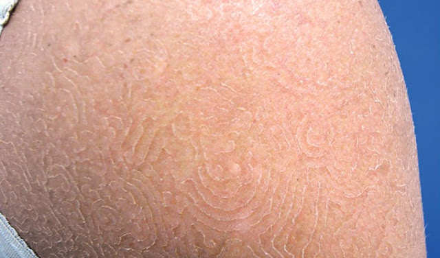 Tinea imbricata Nedir? Belirtileri, Nedenleri, Tanısı ve Tedavisi