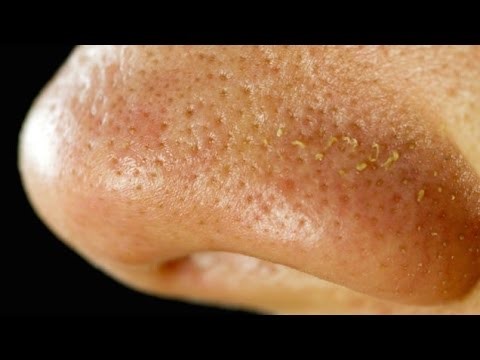 ΕΝΔΙΑΦΕΡΟΥΣΕΣ ΦΩΤΟΓΡΑΦΙΕΣ ΠΡΟΣΒΟΛΗΣ ΑΠΟ DEMODEX (ΝΤΕΜΟΝΤΕΞ) ~ ΠΡΟΤΥΠΟ ...