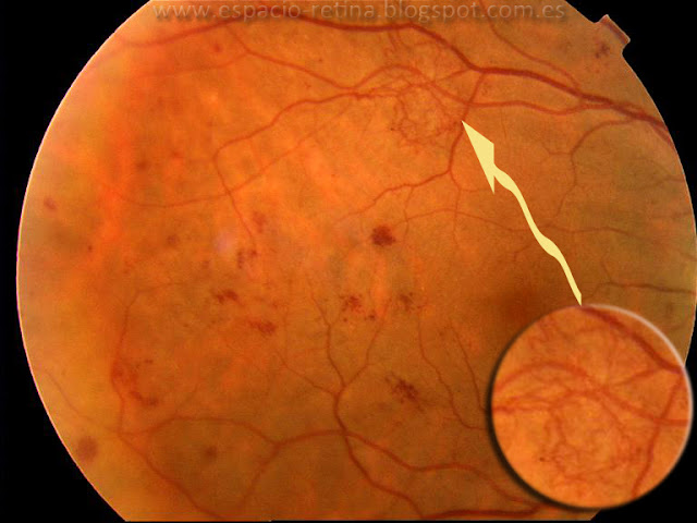 ESPACIO RETINA: Retinopatía diabética.