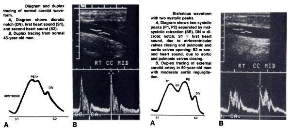 The Pump and the Tubes: The Pulse Sometimes Strikes Twice