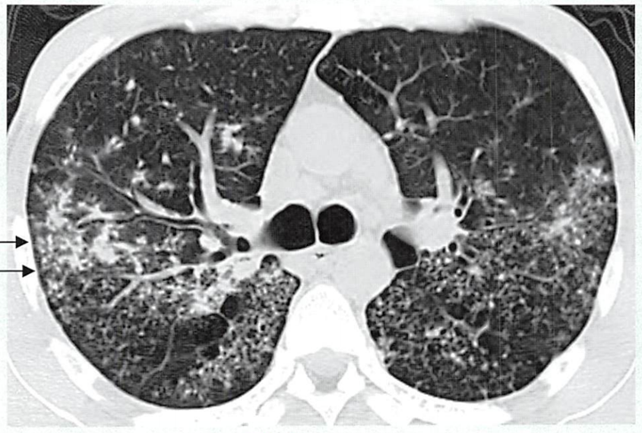 大垣市民病院 呼吸器内科 : tree-in-bud appearance